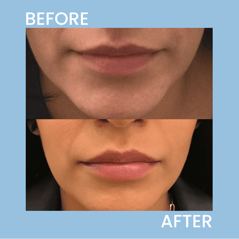 Lip Filler Injections in New York, New Jersey, and Miami - Verve ...