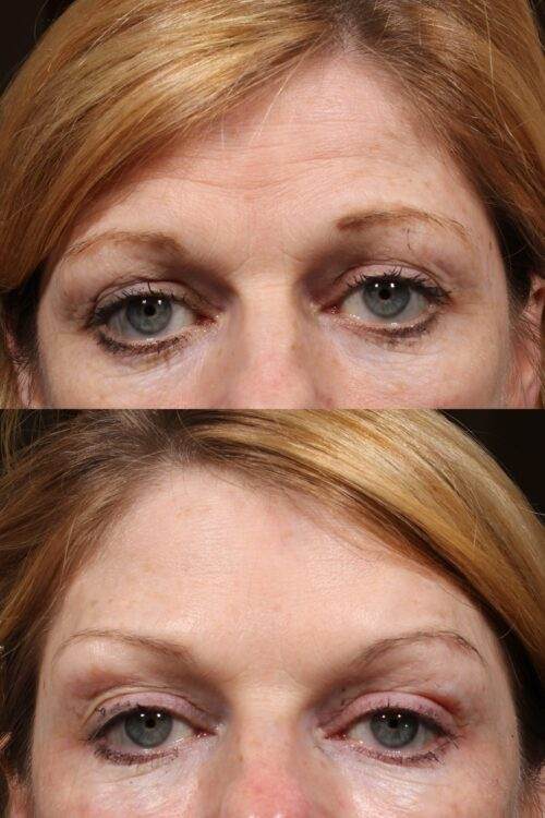 BrowRise™ Non Surgical Brow Lift NYC | Photos, Pricing