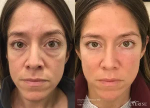 Before & After| Verve Medical Cosmetics | Dr. Stephen Bracci, MD