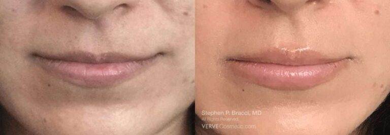 Lip Filler Injections| Verve Medical Cosmetics | Stephen Bracci, MD
