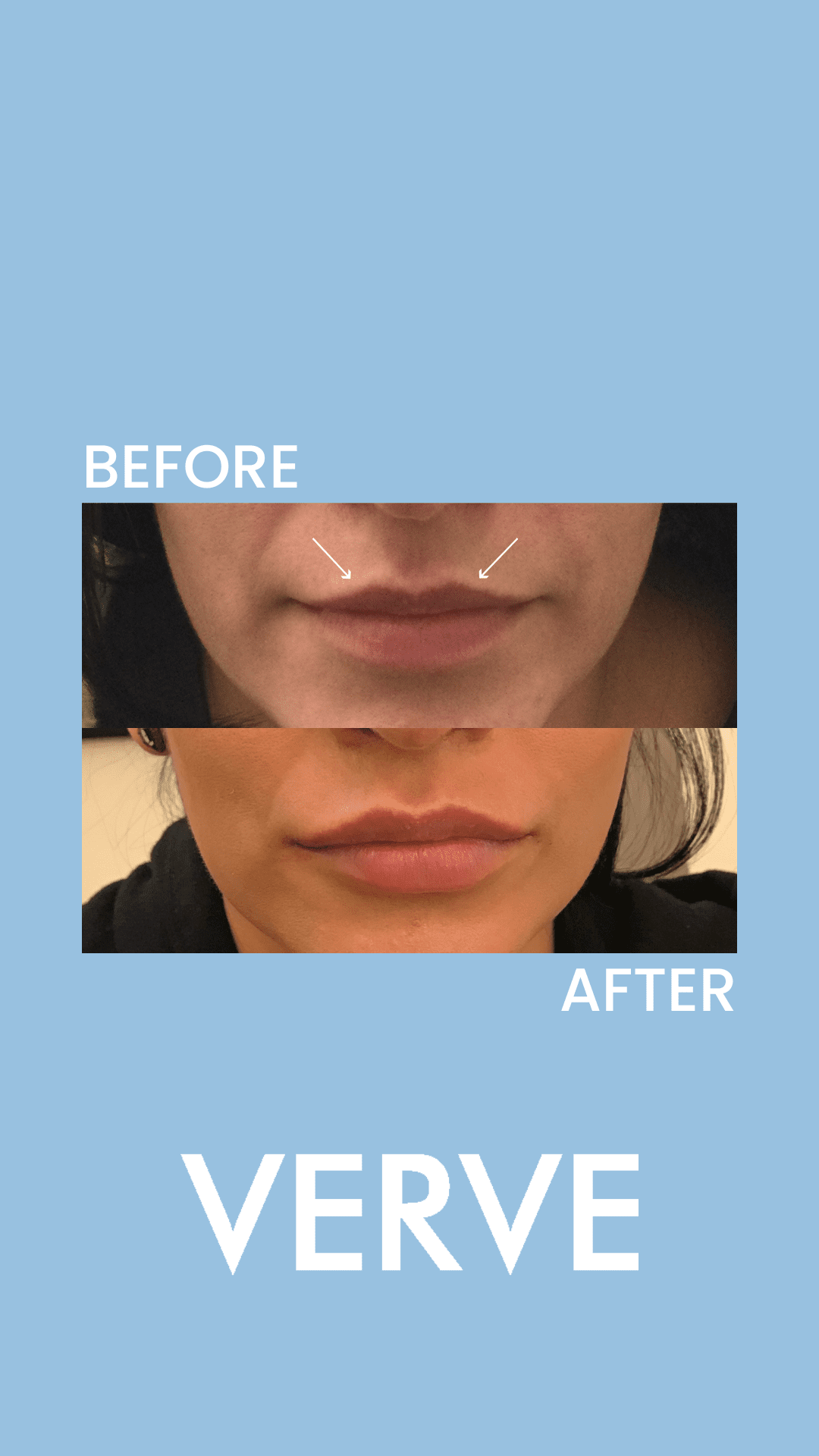 Lip Filler Injections| Verve Medical Cosmetics | Stephen Bracci, MD