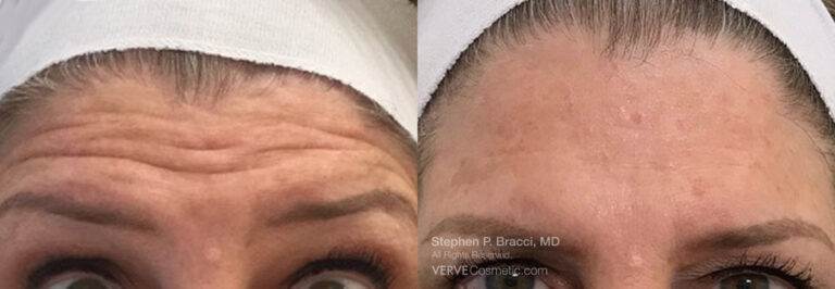 My Friend Has Too Much Botox. What Do I Say? - Verve Medial Cosmetics