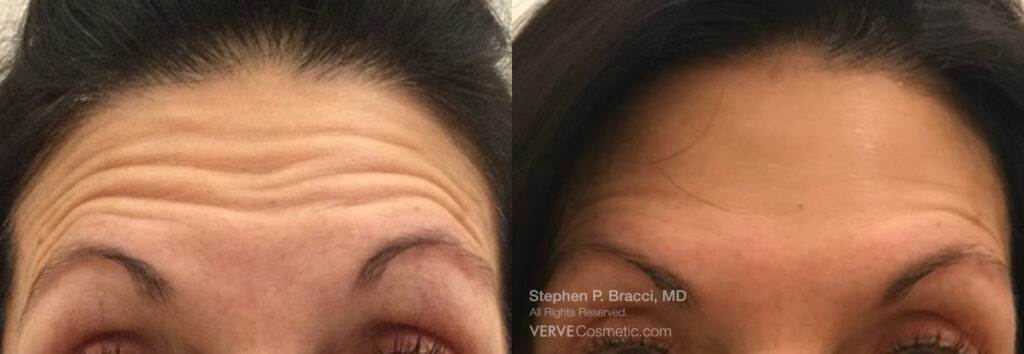 Medical Cosmetic Injections, Fillers, Botox In NYC NJ Miami