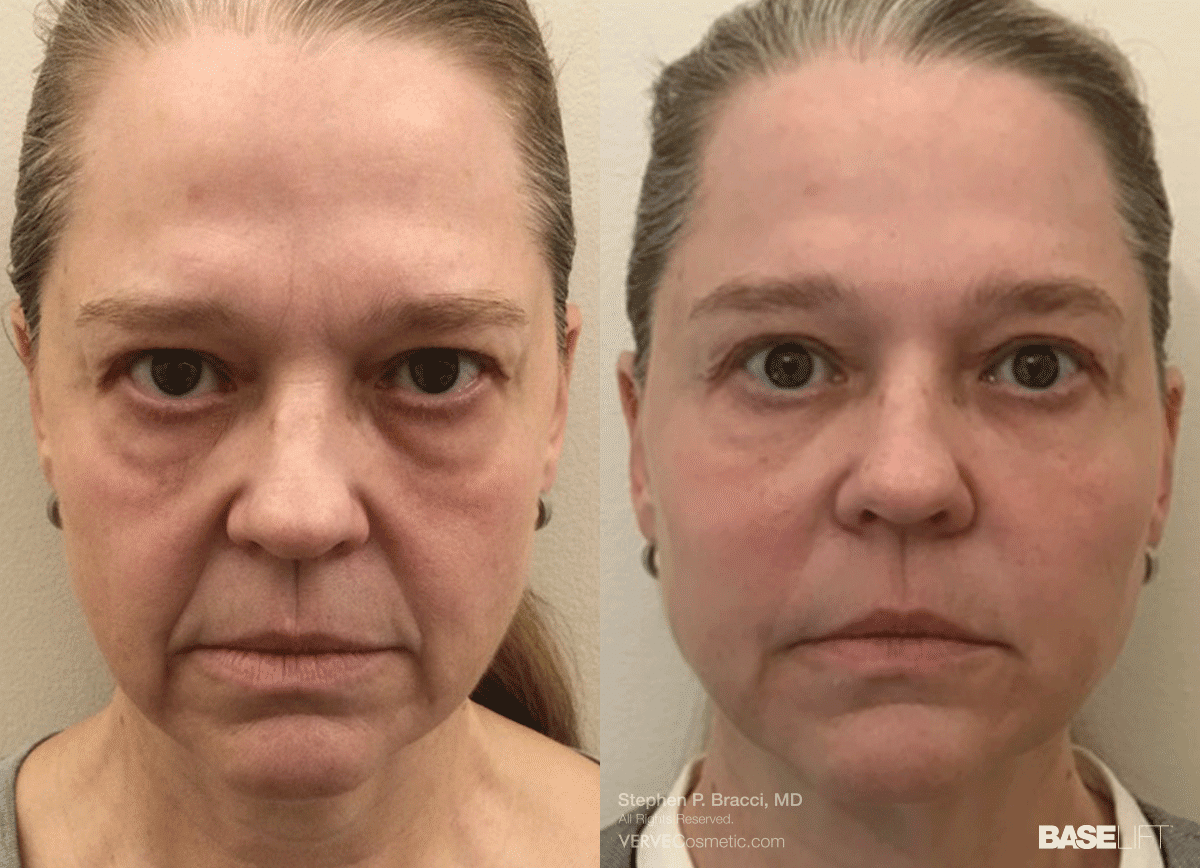 Non Surgical Facelift Before And After - Before & After Results
