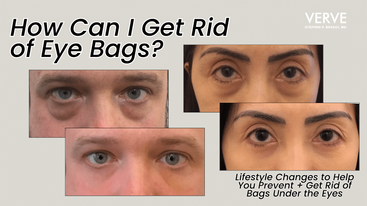 How Can I Get Rid Of Eye Bags? | Lifestyle Changes To Help You Prevent ...