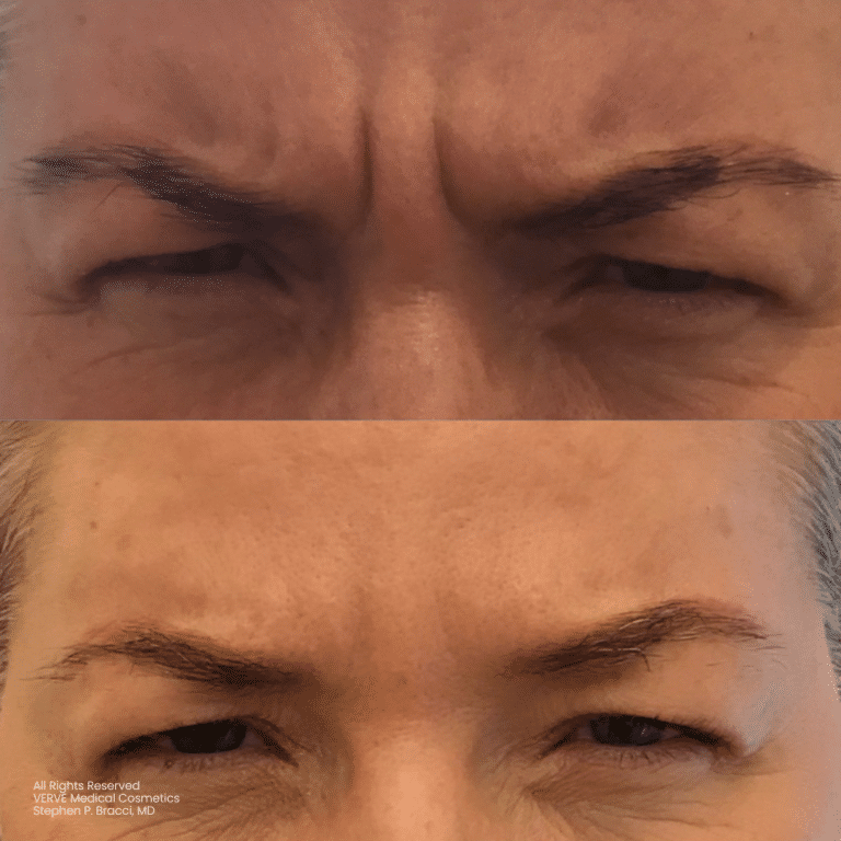 Botox Before And After Pictures: What Should I Look For? - Blog