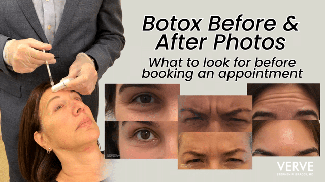 Botox Before And After Pictures: What Should I Look For? - Blog