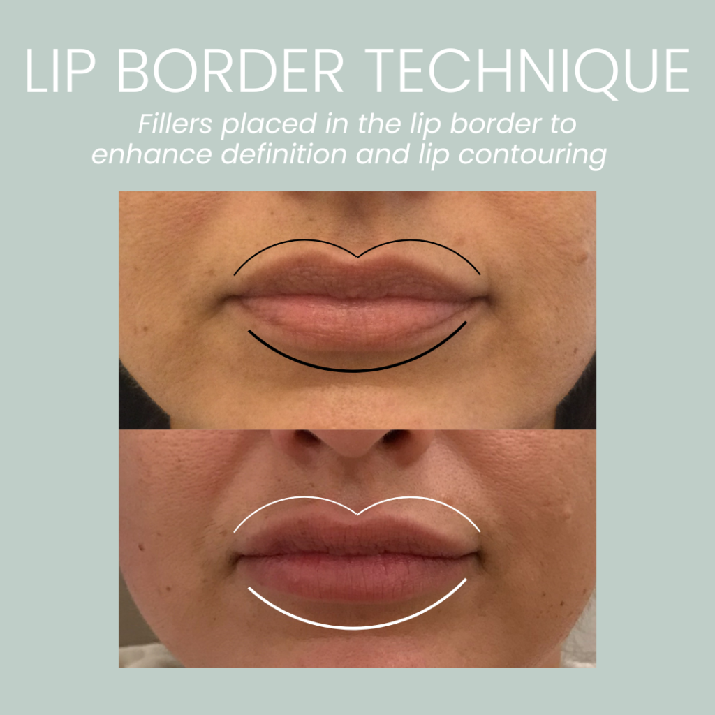 Lip Injection Specials At Verve Medical Cosmetics | Stephen Bracci, MD