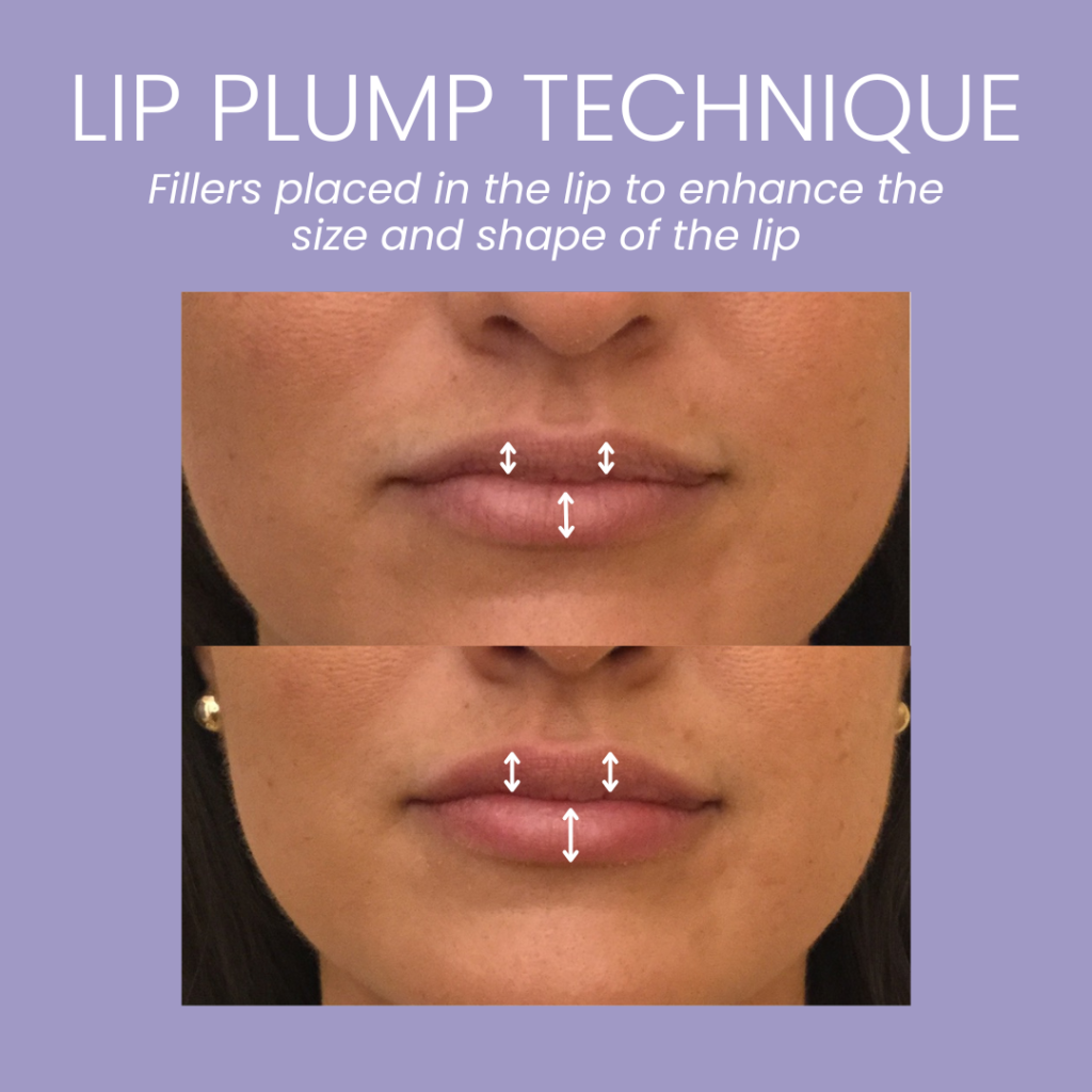 Lip Injection Specials At Verve Medical Cosmetics | Stephen Bracci, MD