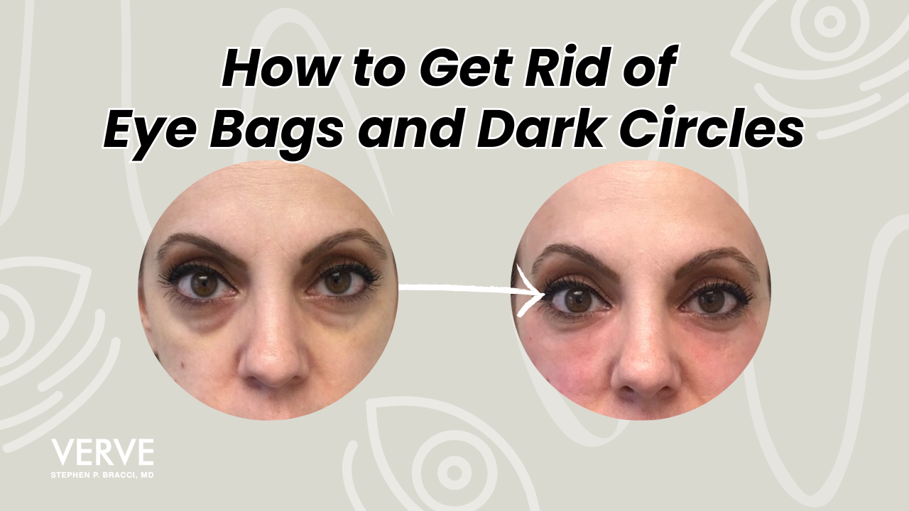 How To Get Rid Of Bags Under Eyes And Dark Circles - Blog
