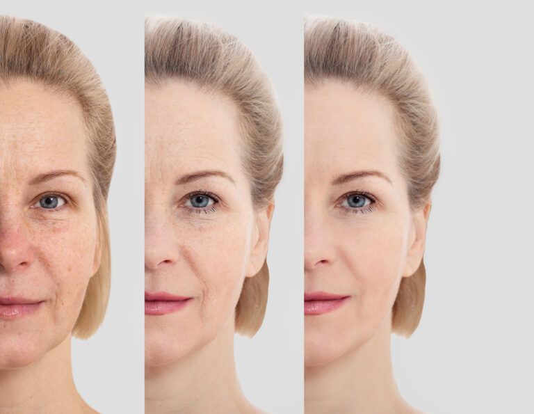 Microneedling before and after gallery - Verve Medical Cosmetics ...