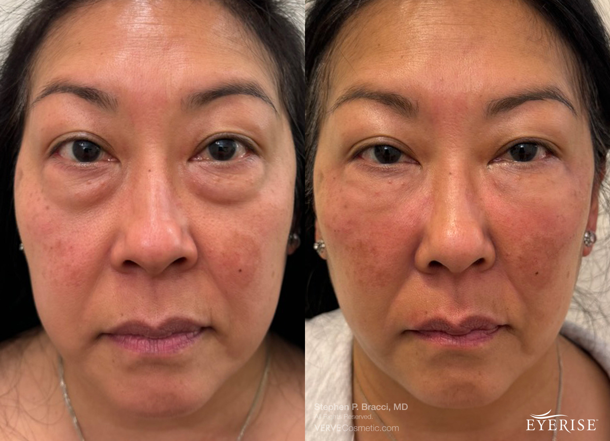 Under Eye Bags Before & After Photos Without Surgery at VERVE